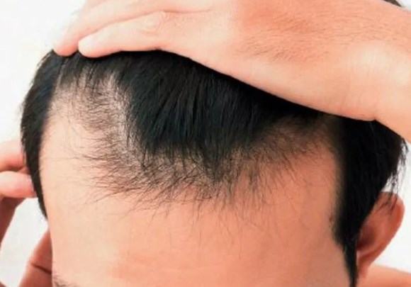 Crooked Hairline: Why It Happens & How to Fix? - Hair System