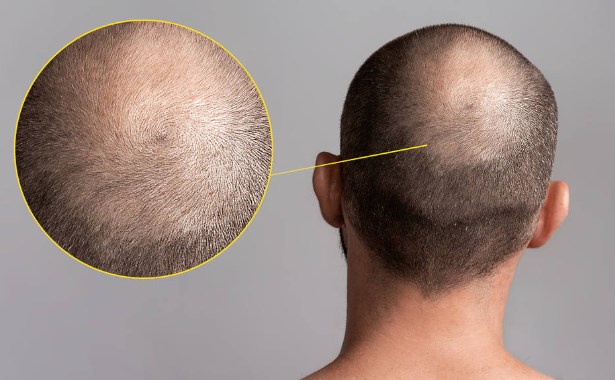 What Causes Crown Hair Loss and How to Treat? - Hair System