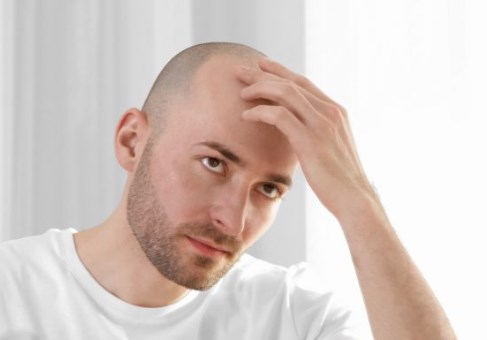 All Baldness Cure and Treatment (2023 Update) - Hair System