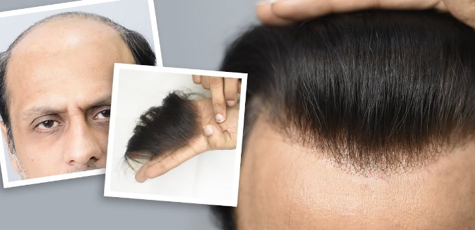 Hair Patch: What Is It, How Long Does It Last, and Where to Buy? - Hair ...