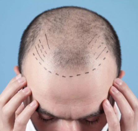 Signs & Treatment: How to Tell If Your Hairline Is Receding? - Hair System