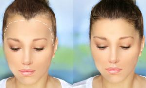 Signs & Treatment: How to Tell If Your Hairline Is Receding? - Hair System