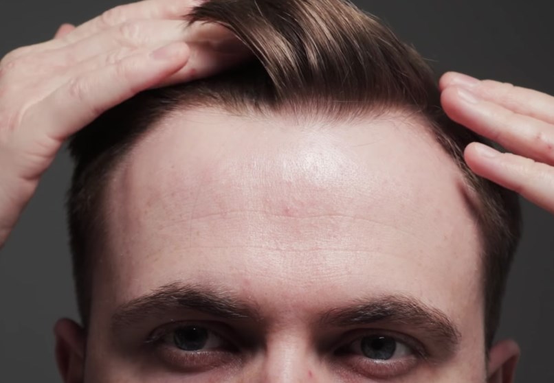How to Fix Your Hairline? All Methods Included! - Hair System