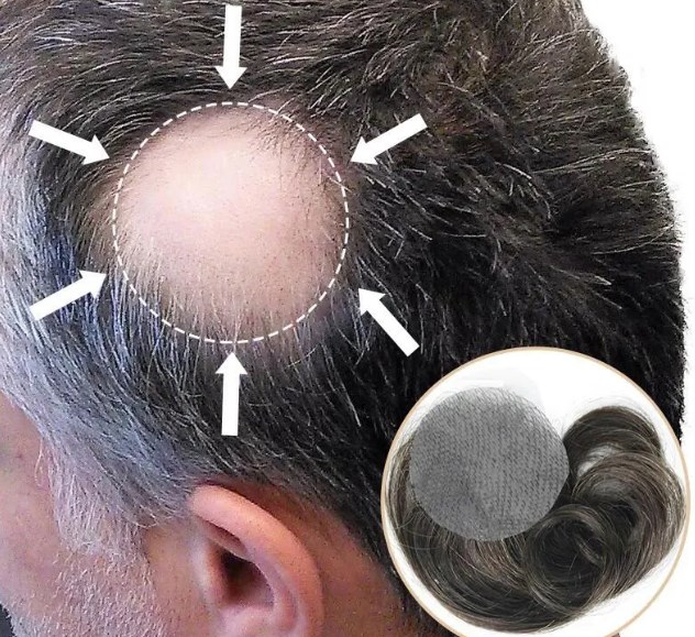 What Are Hair Patches For Bald Spots And Where To Buy? - Hair System